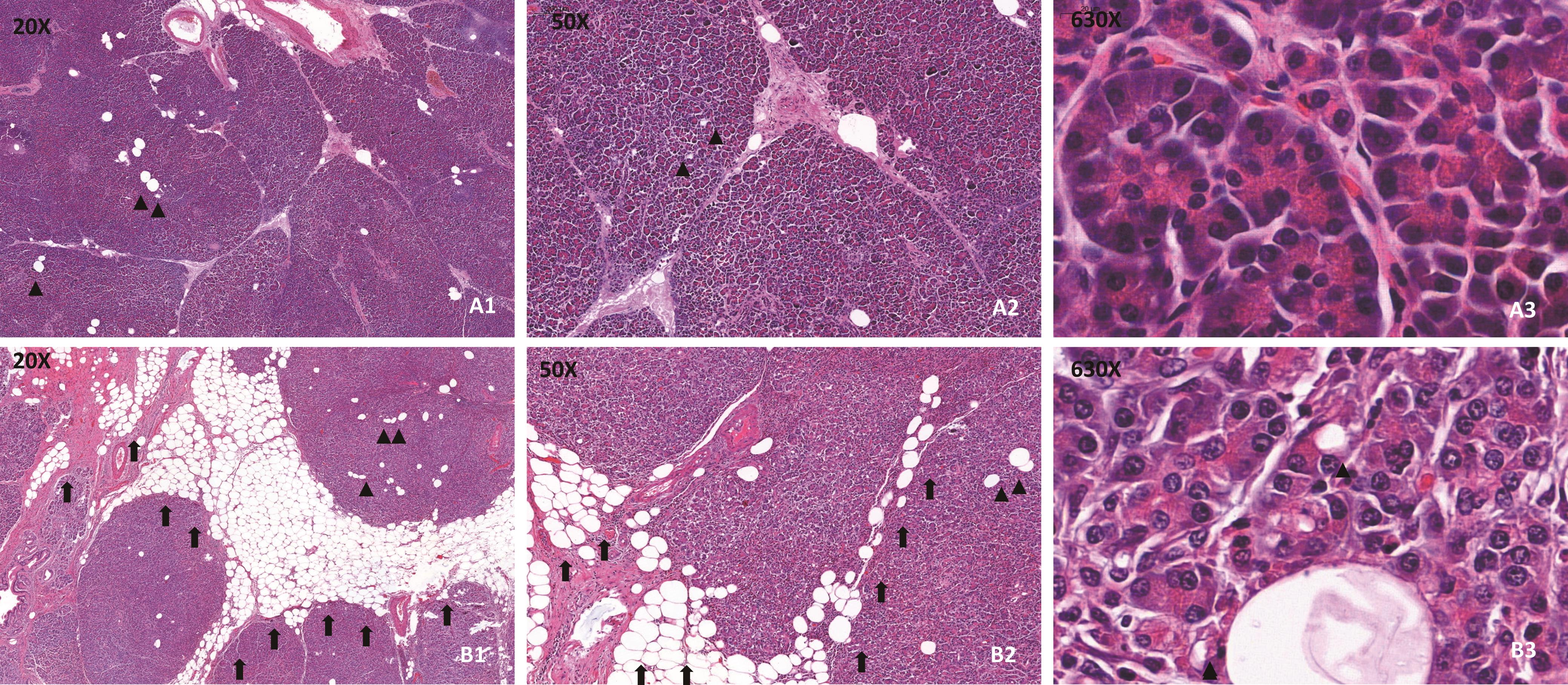 Fatty Pancreas: Linking Pancreas Pathophysiology to Nonalcoholic Fatty ...