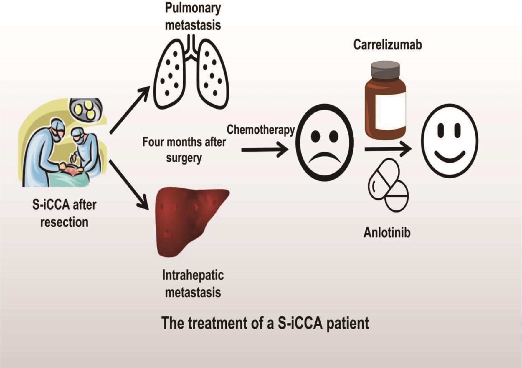 Sarcomatoid Intrahepatic Cholangiocarcinoma After Immunotherapy: A Case ...