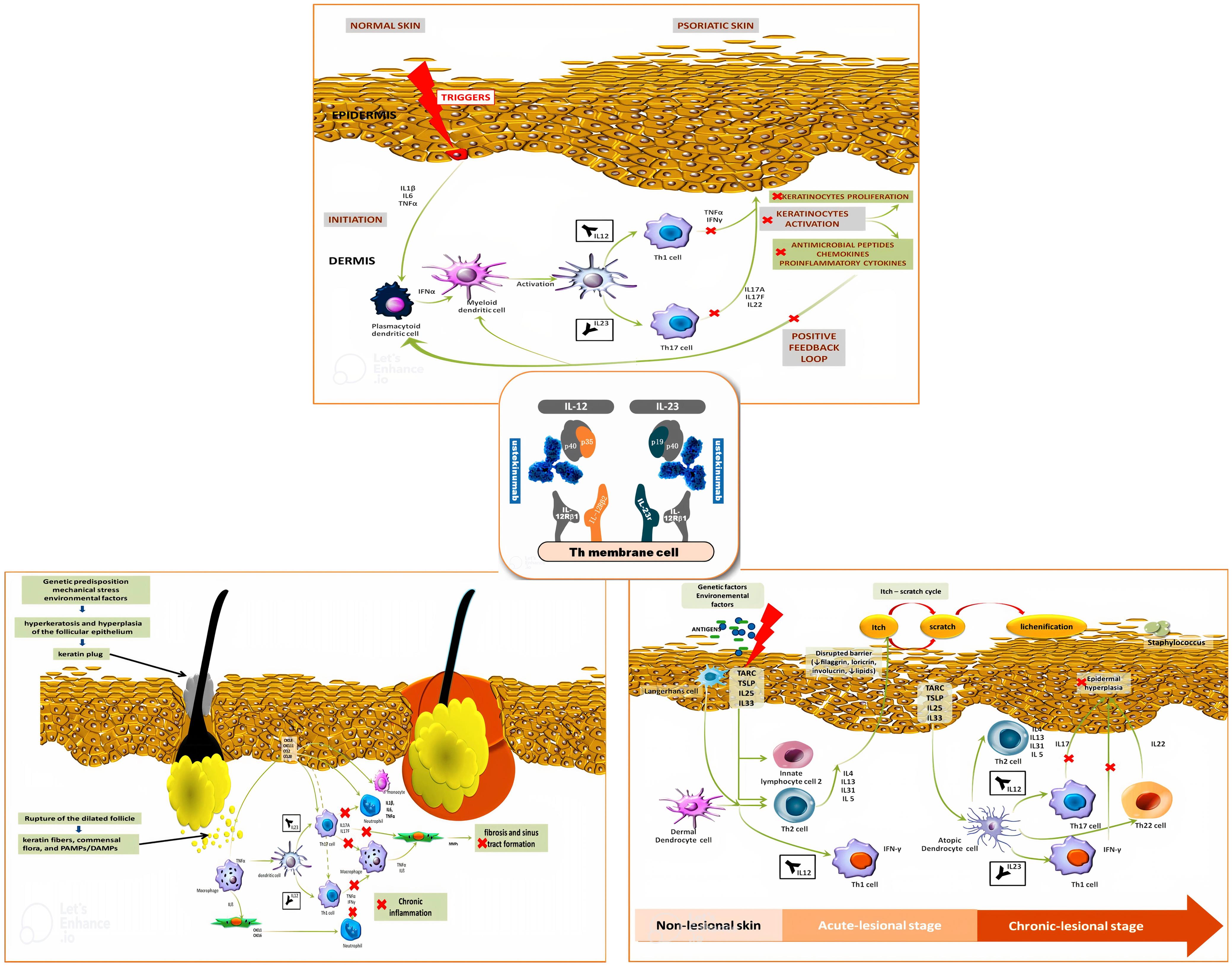 Ustekinumab in Dermatology: Approved Indications and Off-label Uses
