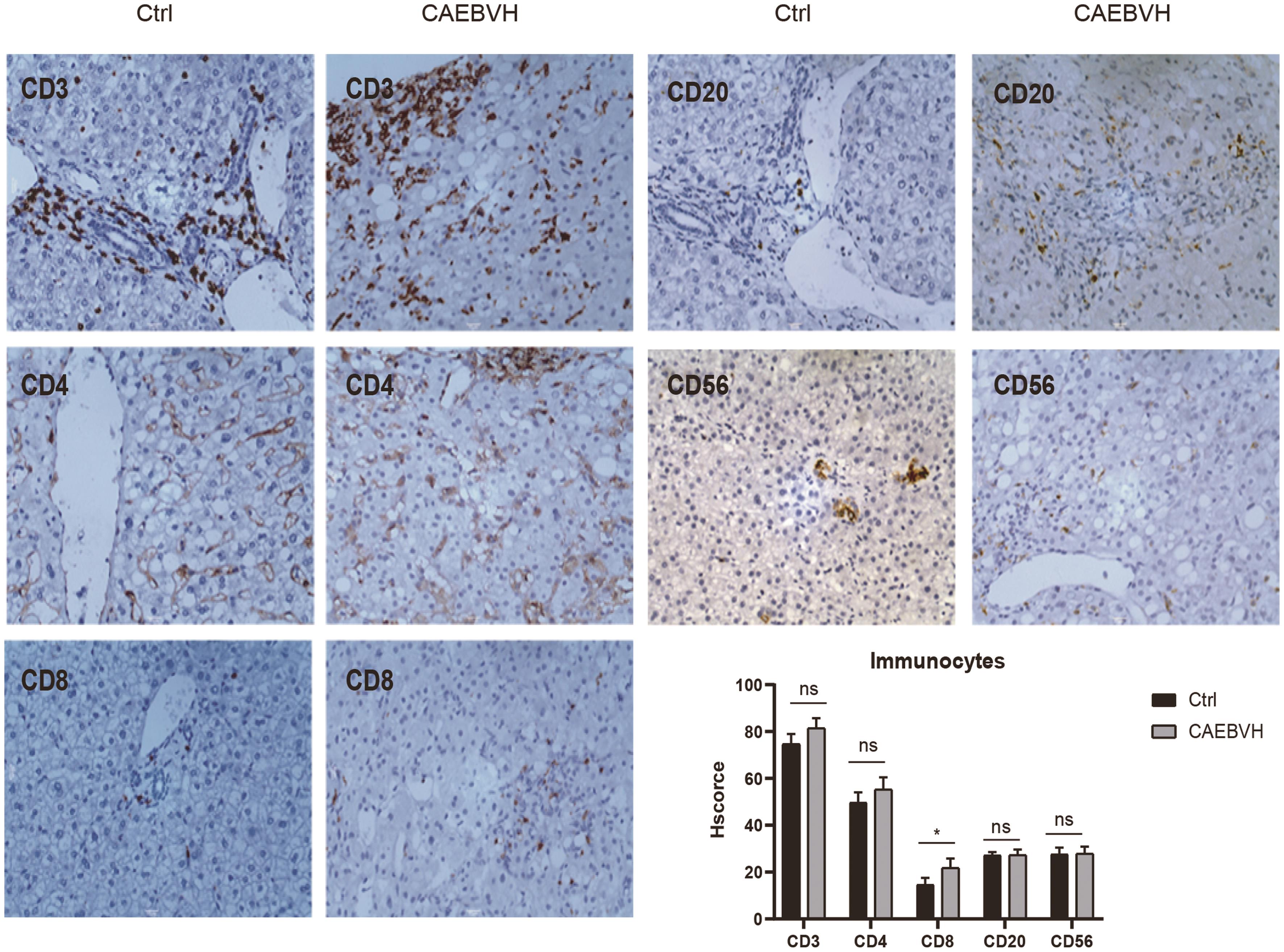 Fas/FasL and Complement Activation are Associated with Chronic Active ...