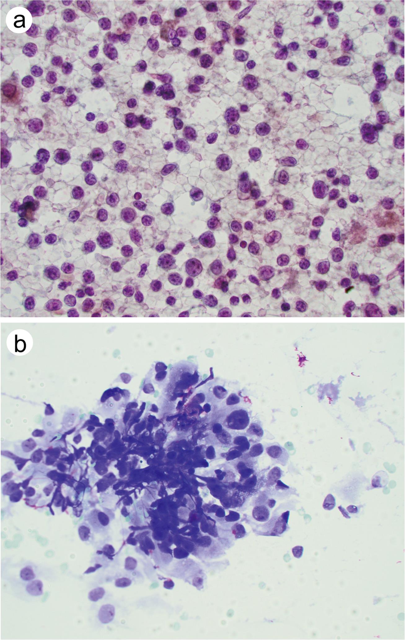 Bethesda System for Reporting Thyroid Cytopathology–An Updated Review