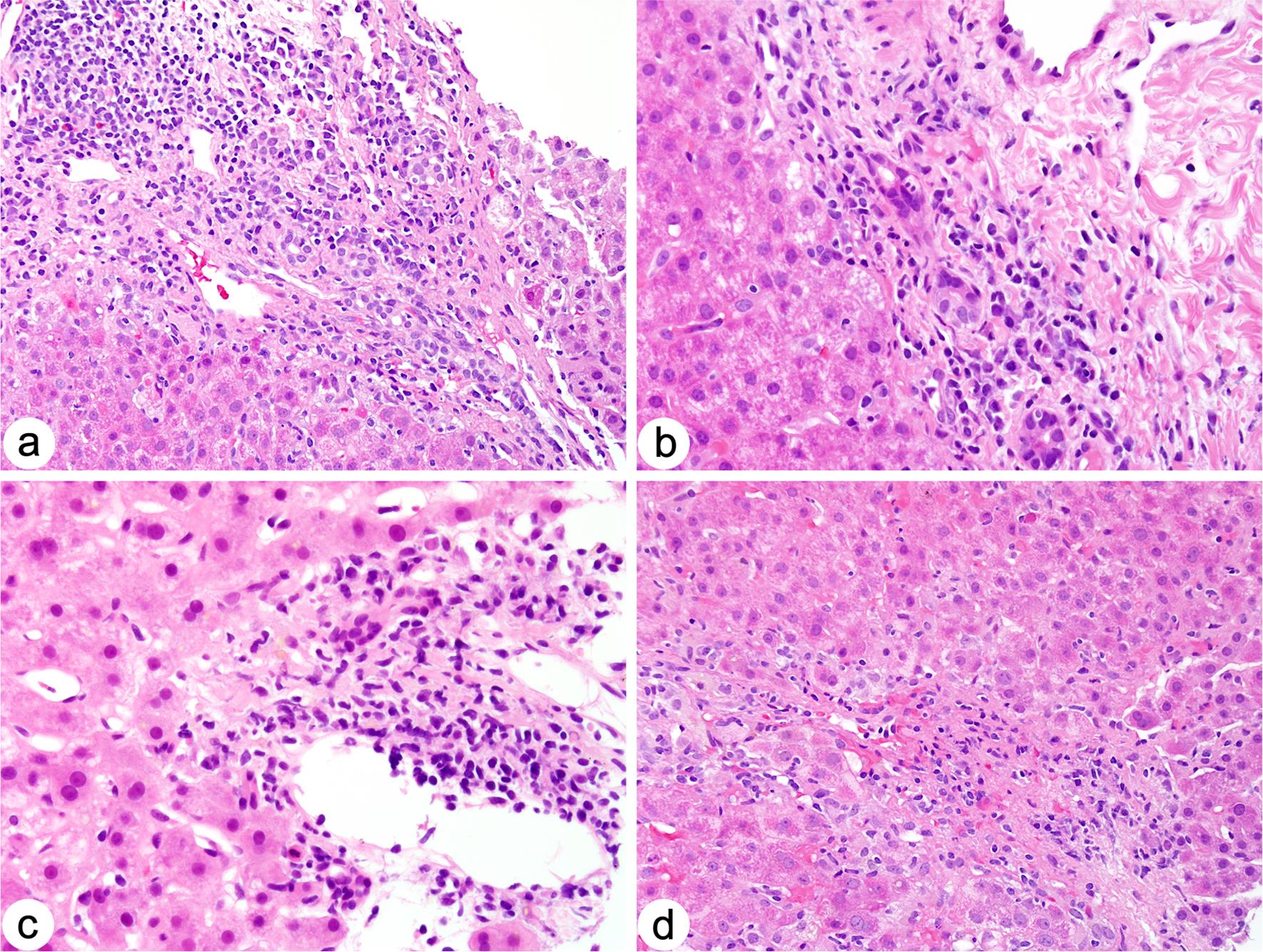 Histopathological Evaluation of Recurrent Primary Biliary Cholangitis ...
