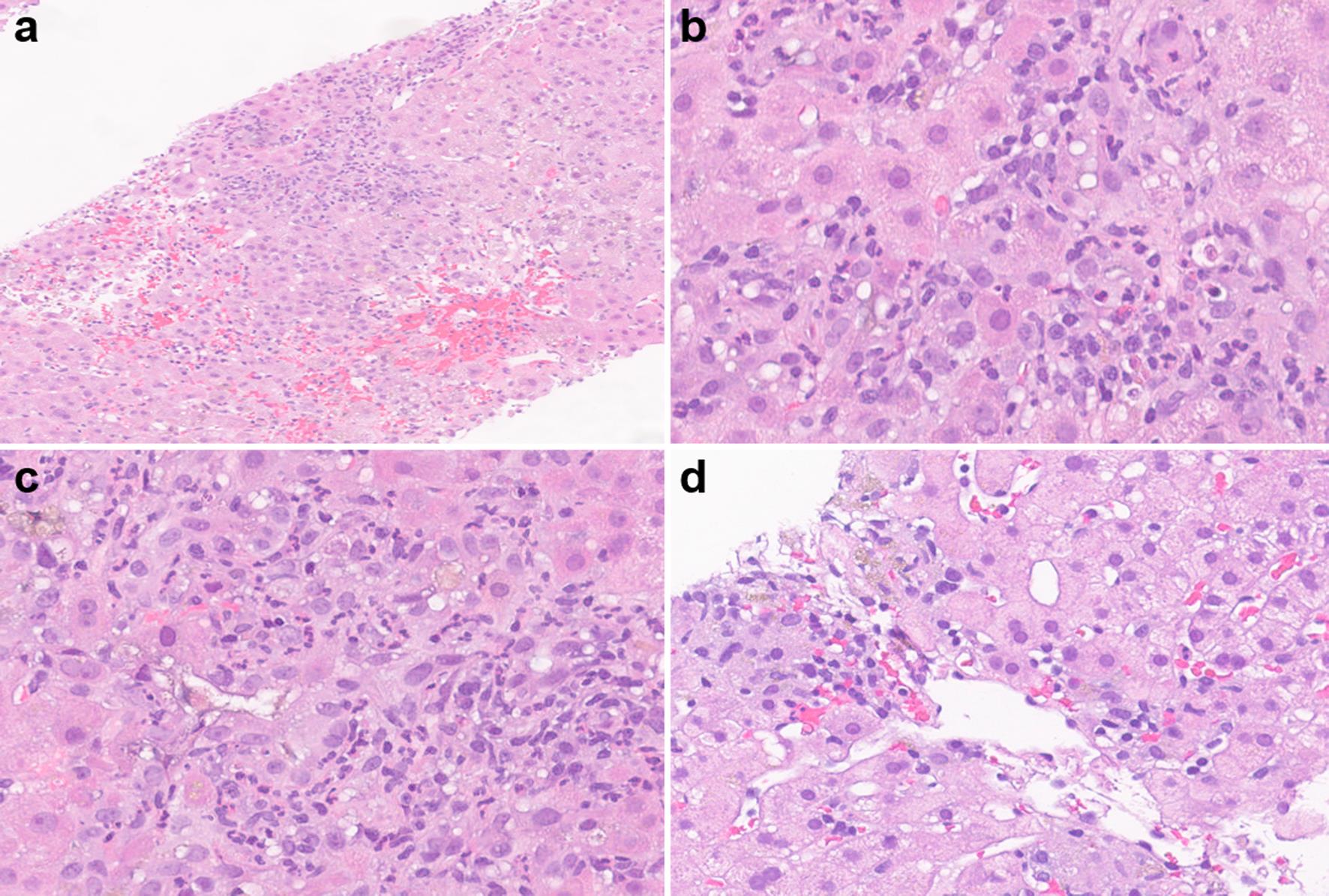 Immune Checkpoint Inhibitor-Induced Hepatic Injury: A Clinicopathologic Review