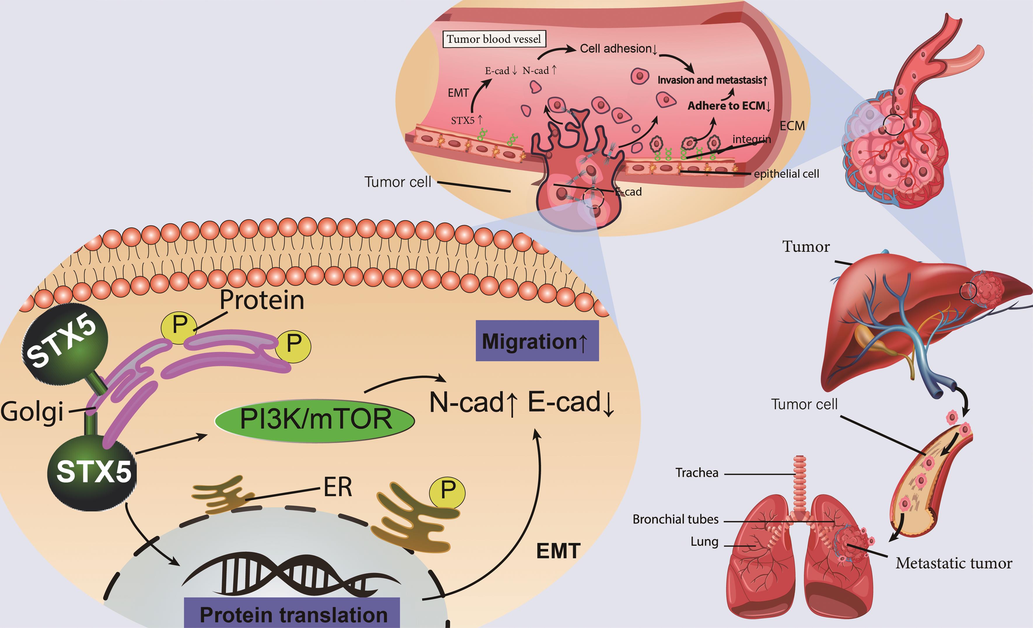 STX5 Inhibits Hepatocellular Carcinoma Adhesion and Promotes Metastasis ...