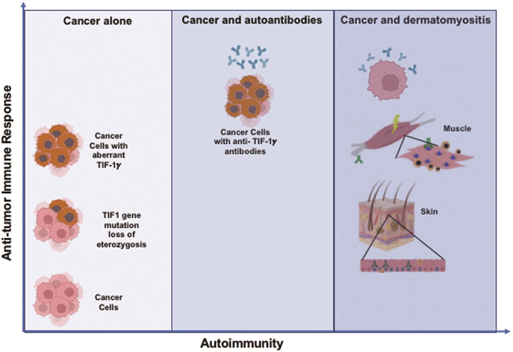 Paraneoplastic Anti-Tif1-gamma Autoantibody-positive Dermatomyositis as ...