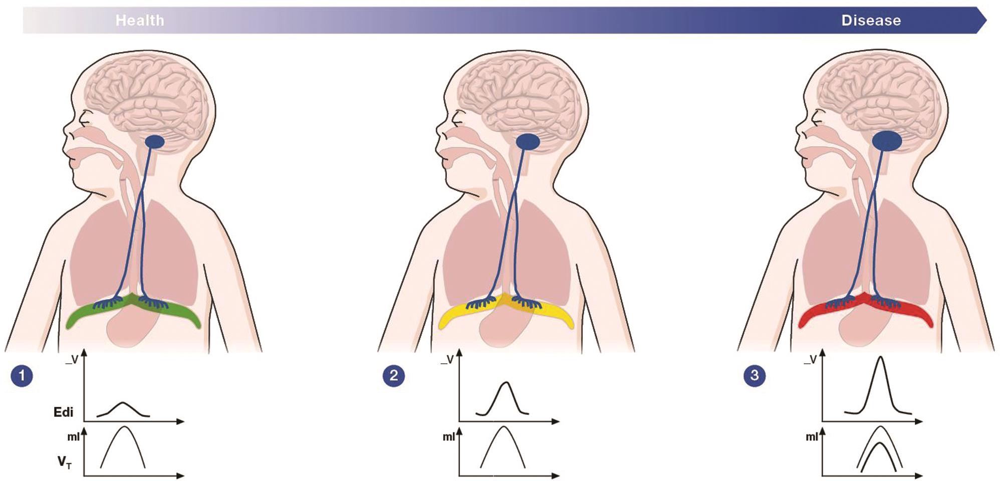 Neurally Adjusted Ventilatory Assist Mode in Pediatric Intensive Care ...