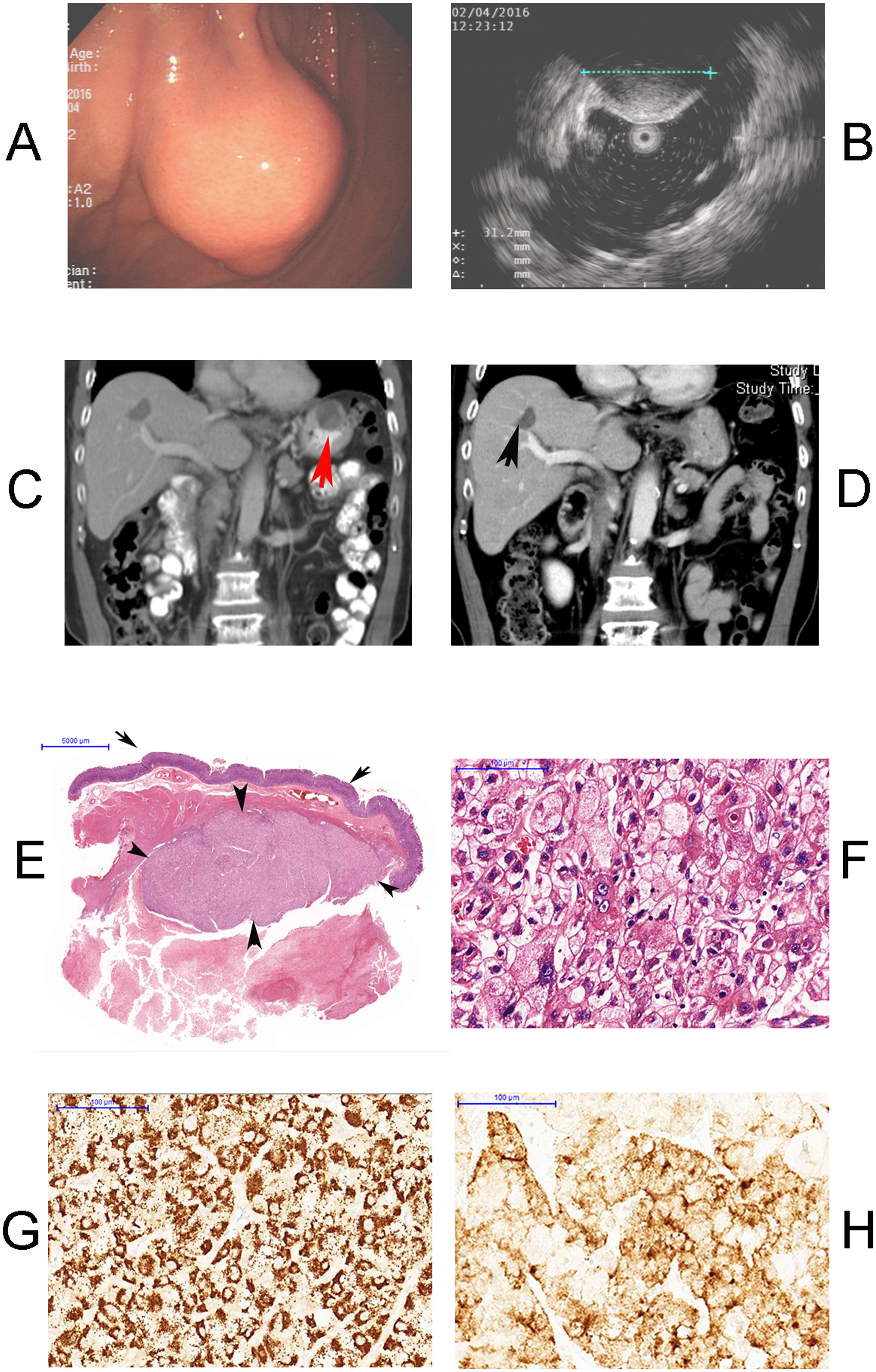 Hepatocellular Carcinoma with Gastric Metastasis Mimicking a 4 cm ...