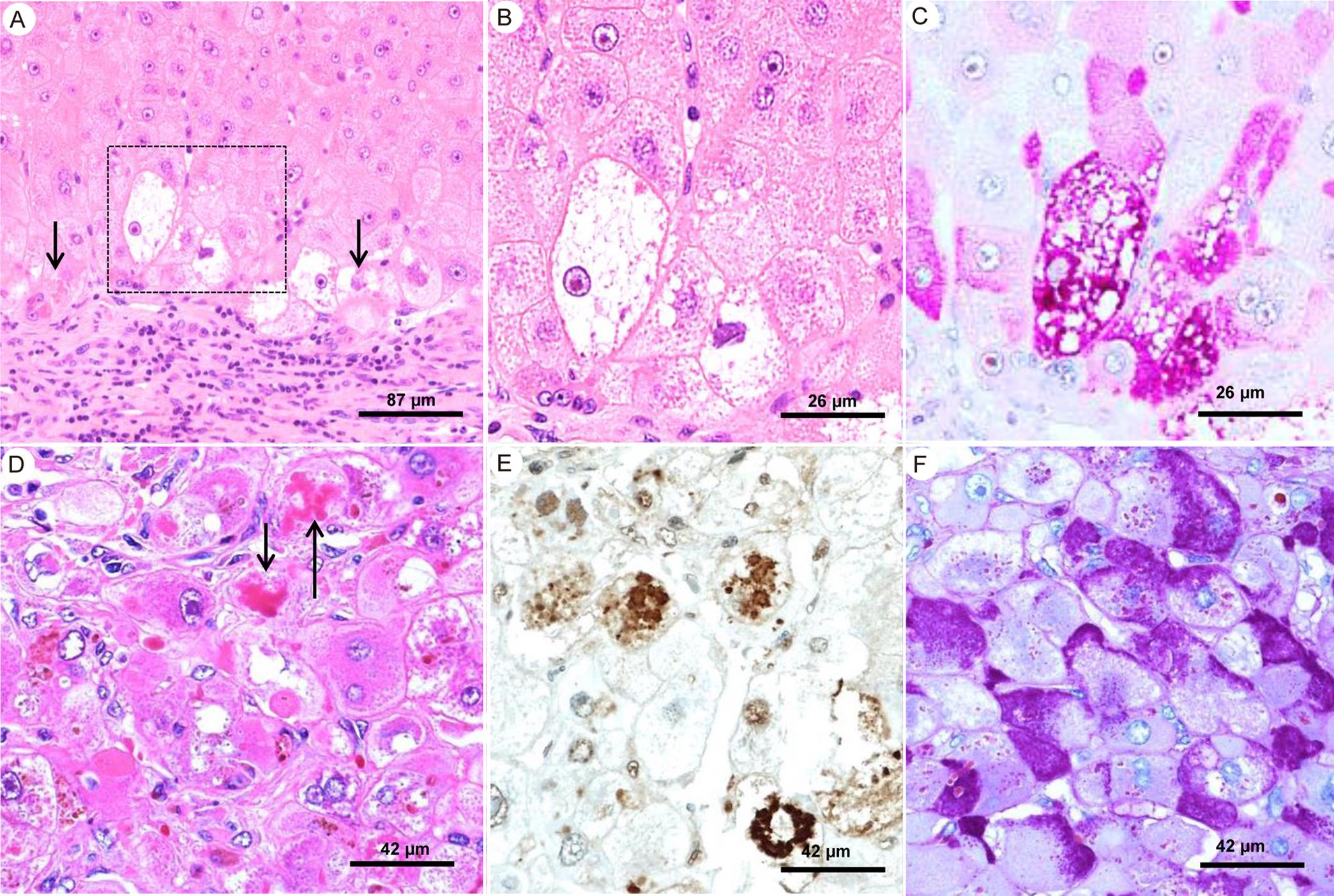 Hepatocellular Ballooning is Due to Highly Pronounced Glycogenosis ...