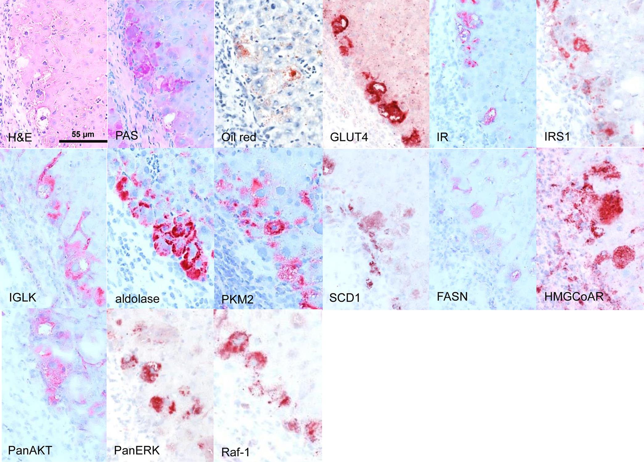 Hepatocellular Ballooning is Due to Highly Pronounced Glycogenosis ...