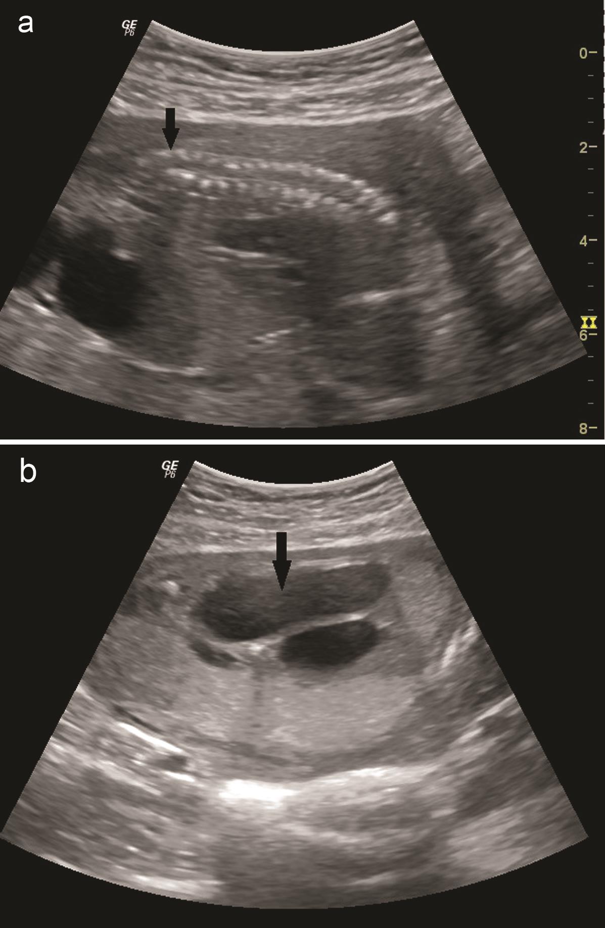 Sirenomelia, the Fetal ‘Mermaid’: Ultrasound and Magnetic Resonance ...
