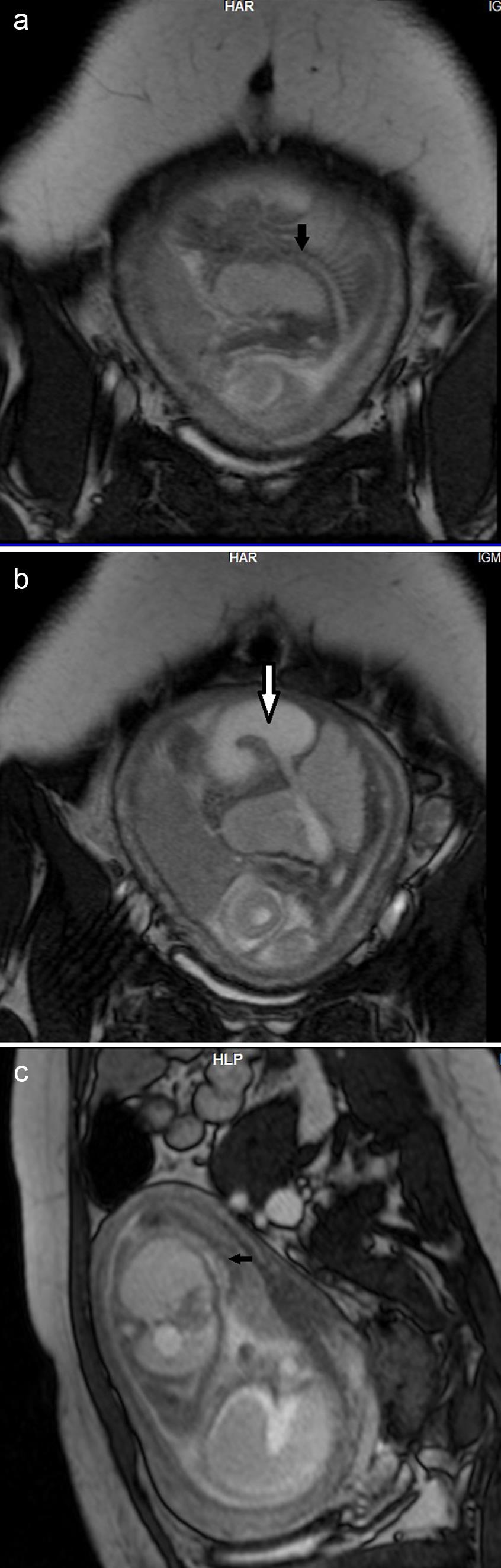 Sirenomelia, the Fetal ‘Mermaid’: Ultrasound and Magnetic Resonance ...