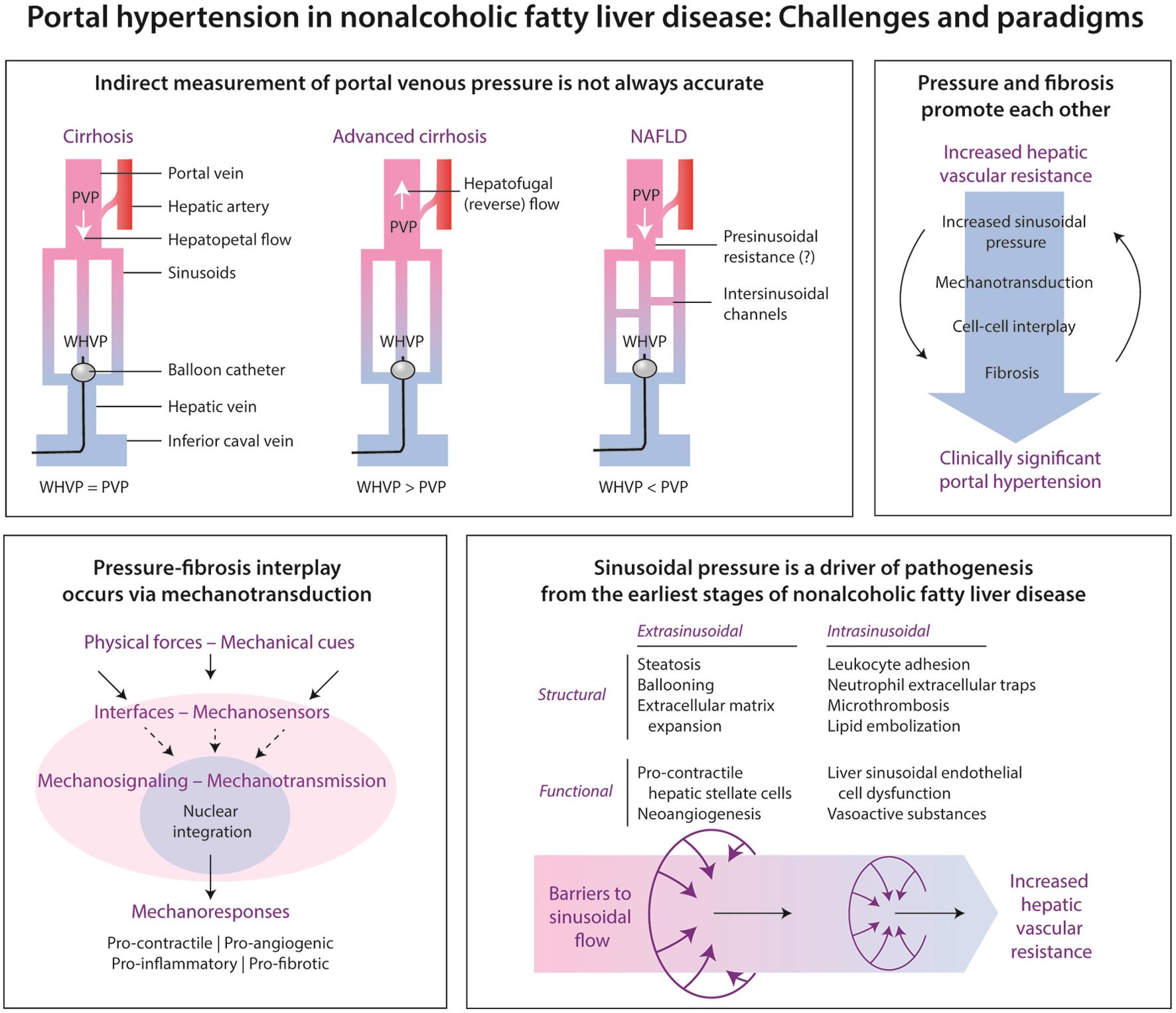 Portal Hypertension in Nonalcoholic Fatty Liver Disease: Challenges and ...