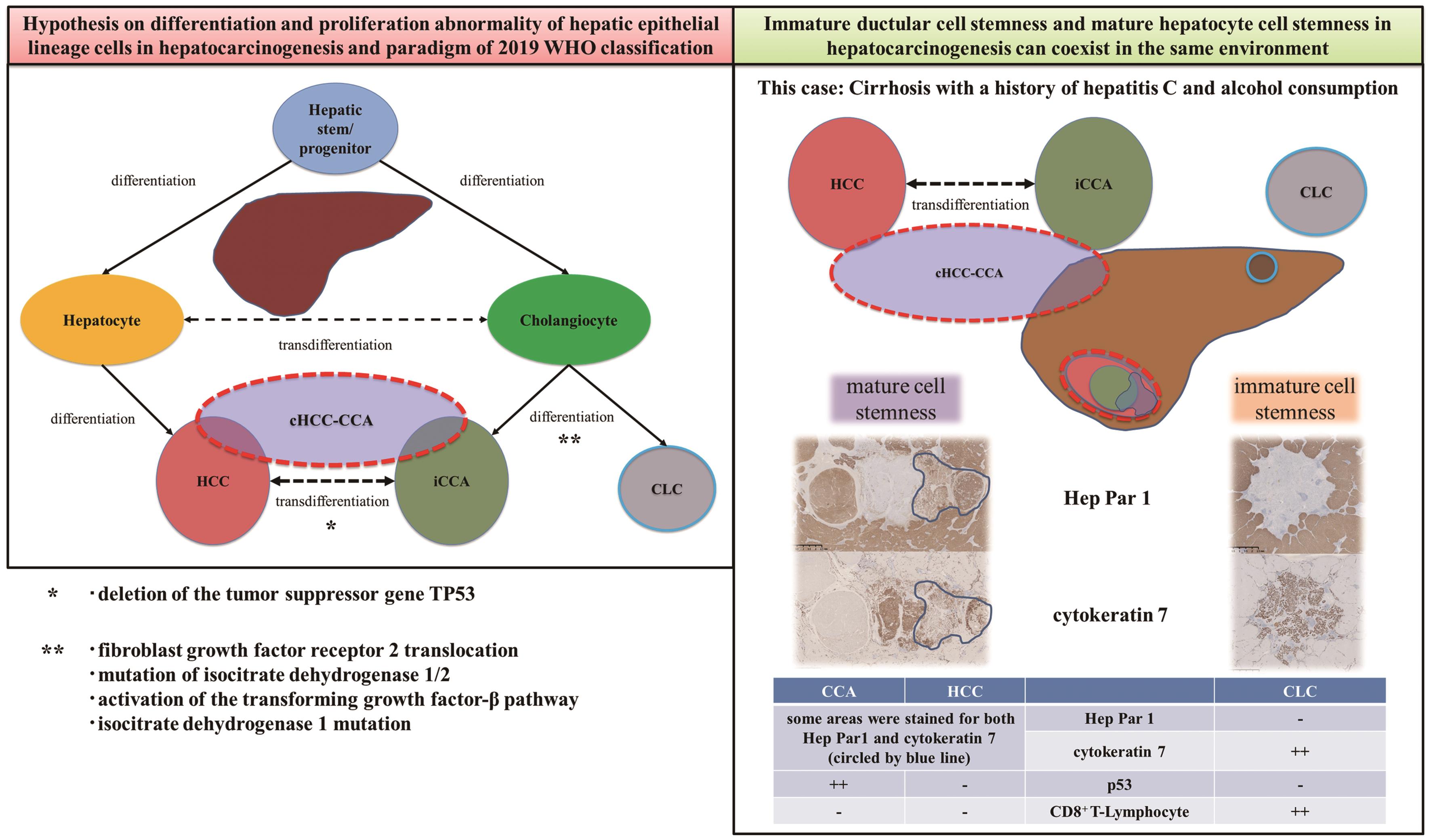 Synchronous Double Primary Combined Hepatocellular-cholangiocarcinoma and Cholangiolocarcinoma ...