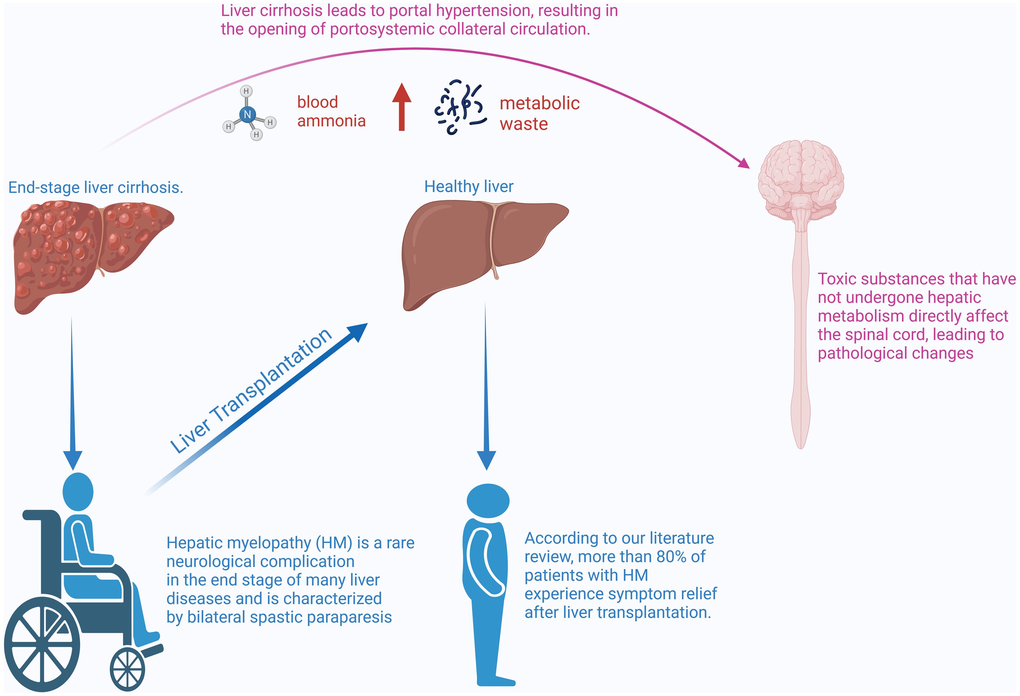 Liver Transplantation Reverses Hepatic Myelopathy in the Decompensated ...