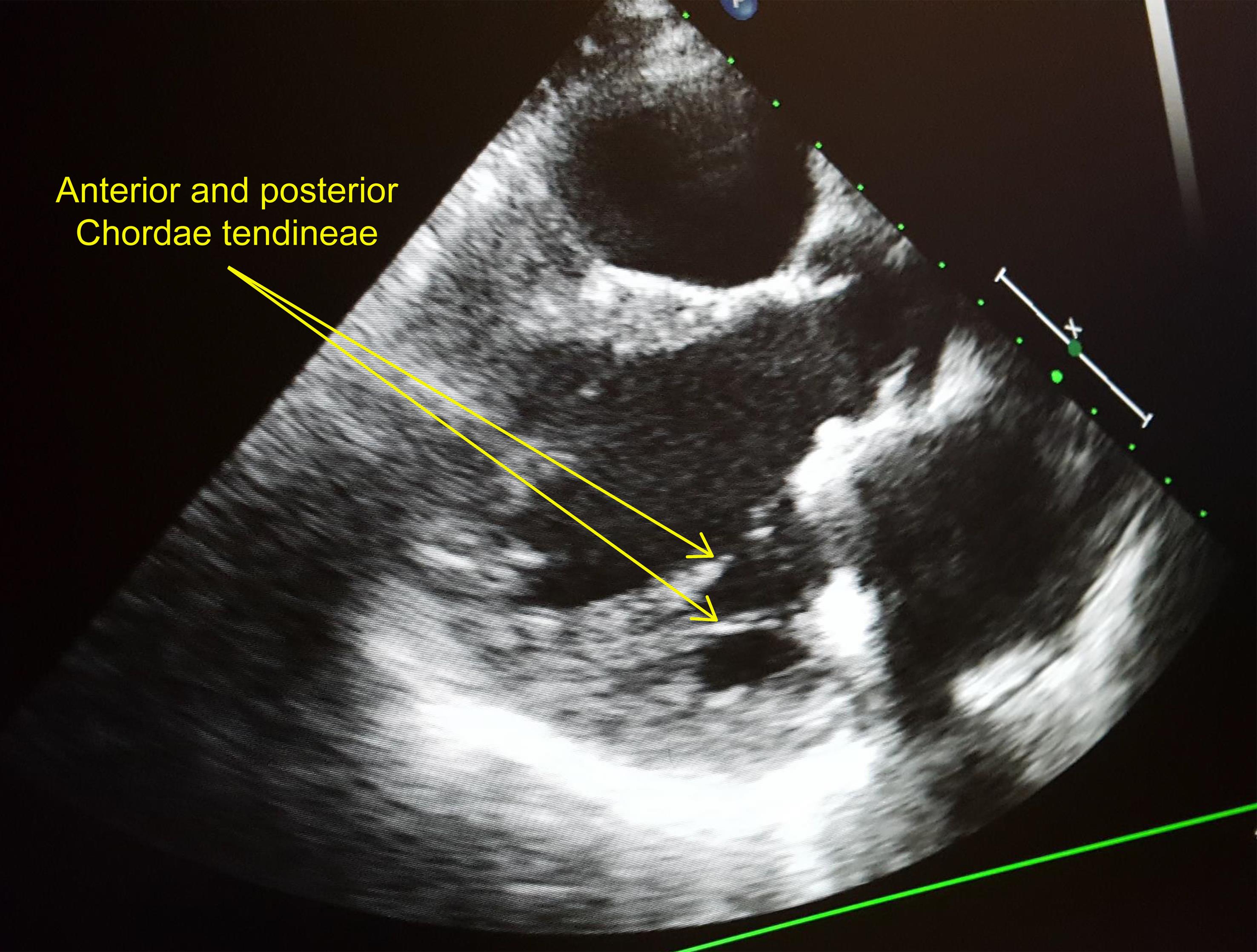 Clampless Beating Heart Mitral Valve Replacement in Dilated Cardiomyopathy