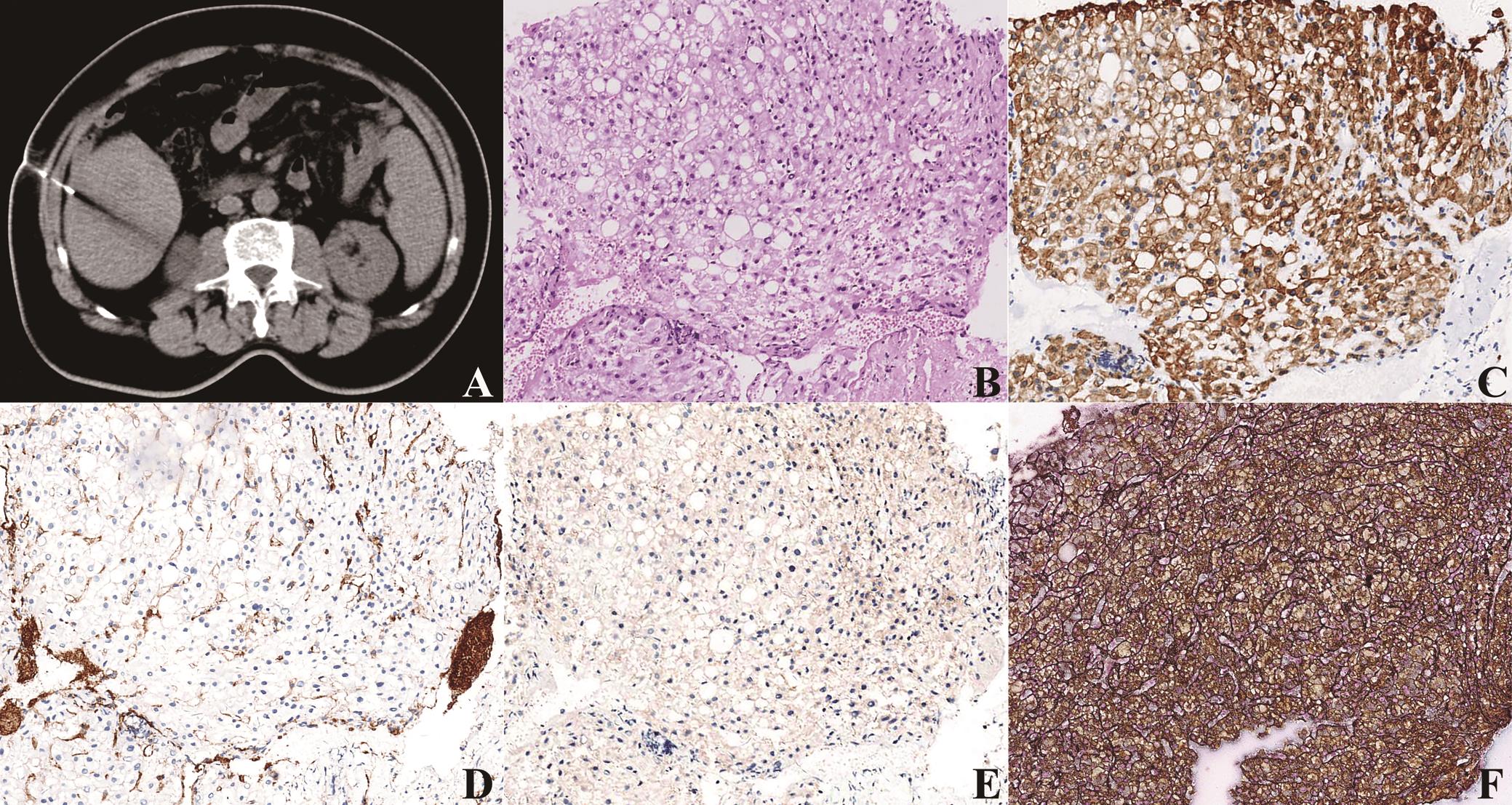 Giant Hepatic Regenerative Nodule in a Patient With Hepatitis B Virus ...
